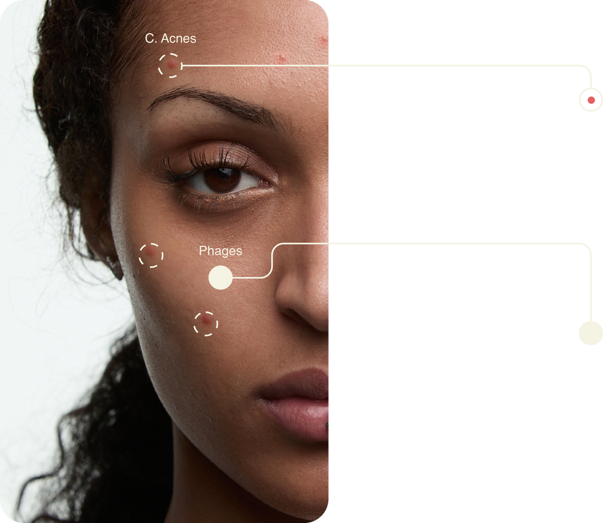 Phyla Acne Skincare – Phyla Skincare